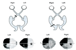 Hemianopsia test: methods and examination instruments - Emianopsia