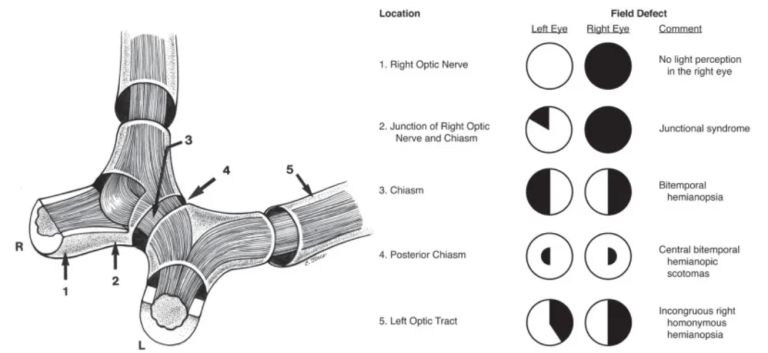 Hemianopsia and diseases of the optic chiasma - Emianopsia