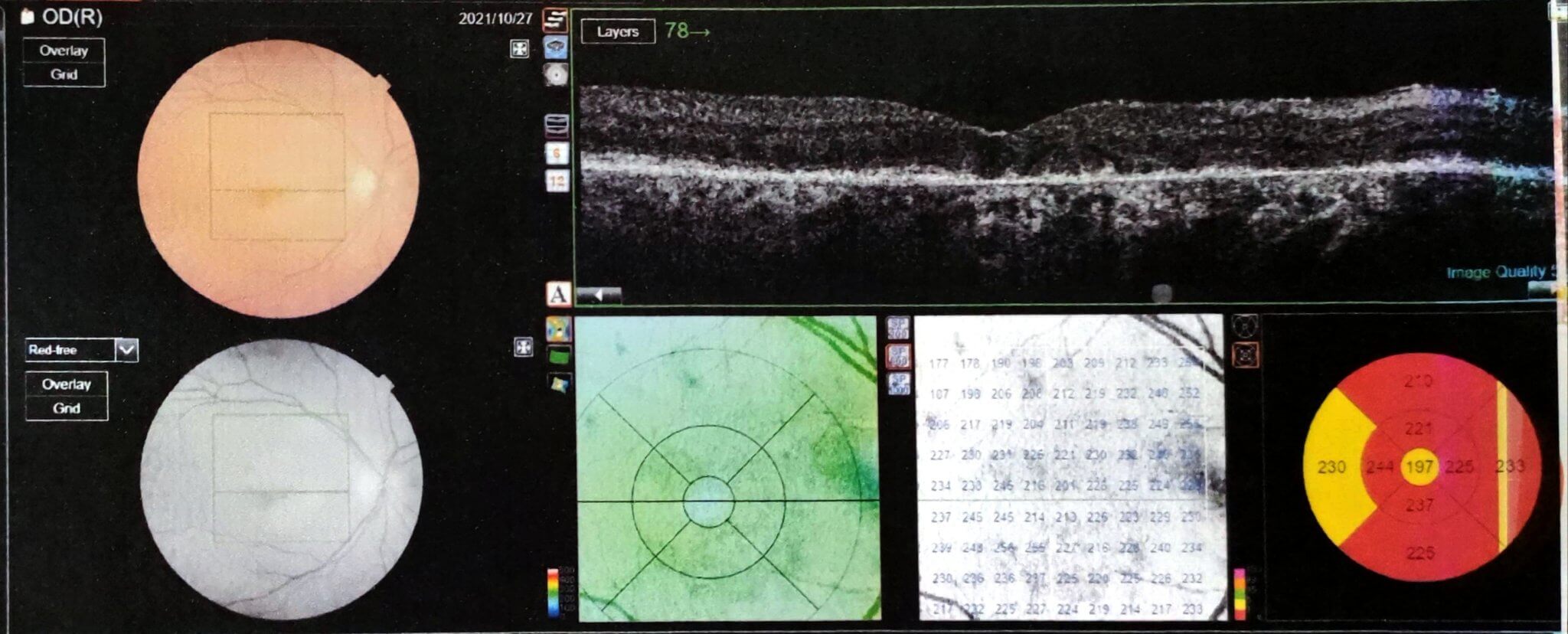 Charles Bonnet syndrome stroke - Emianopsia