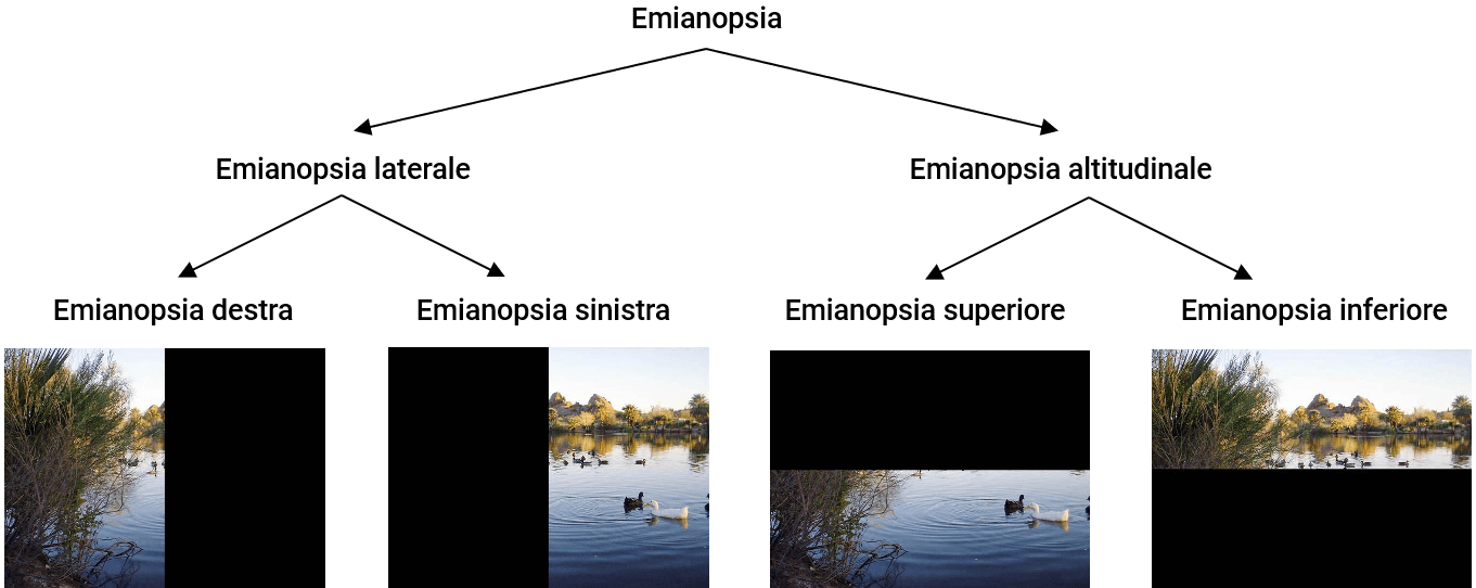 Types of Hemianopias - Emianopsia