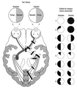 Types of Hemianopias - Emianopsia