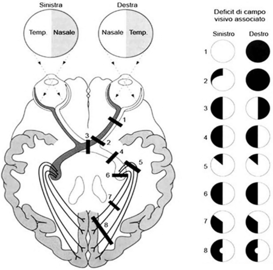 Treatments for patients with hemianopia - Emianopsia