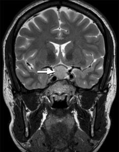 Hemianopia in relation to other pathologies - Emianopsia