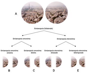Types of Hemianopias - Emianopsia