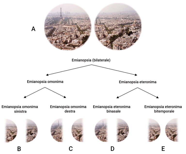 Types of Hemianopias - Emianopsia