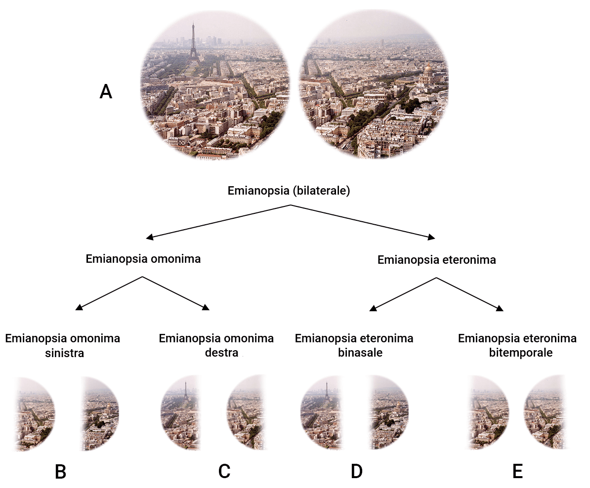 Types of Hemianopias - Emianopsia